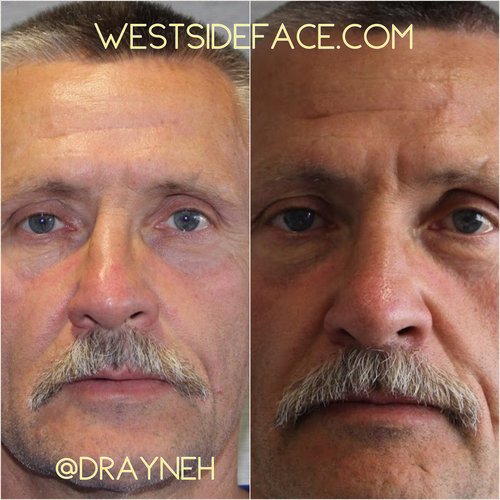 Male Reconstructive Rhinoplasty
