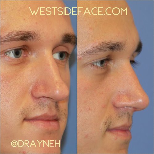 Male Rhinoplasty - Westside Face