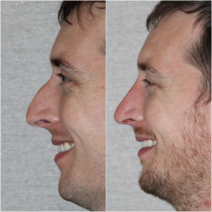 Crooked Nose Repair - Westside Face
