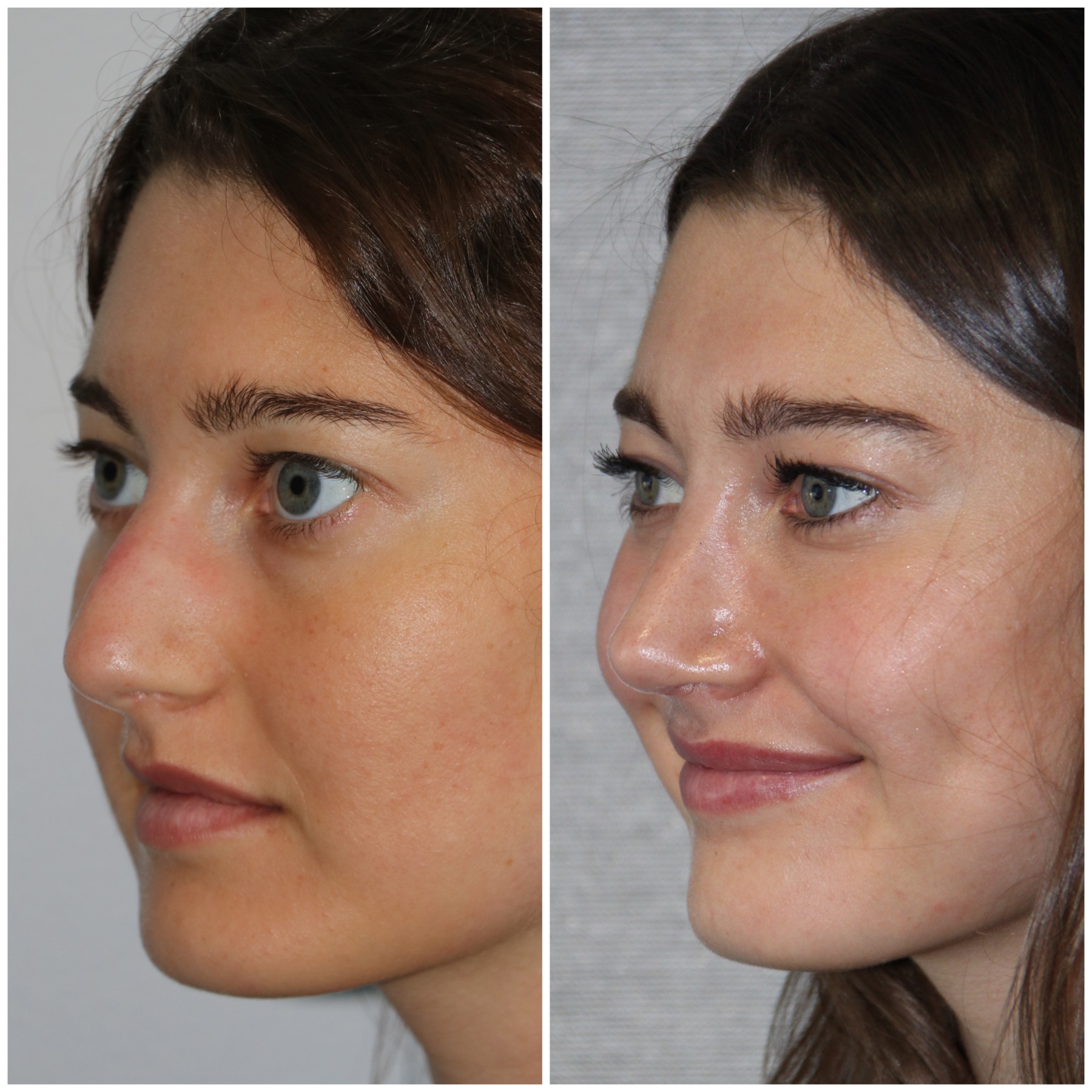 Female Rhinoplasty - Westside Face