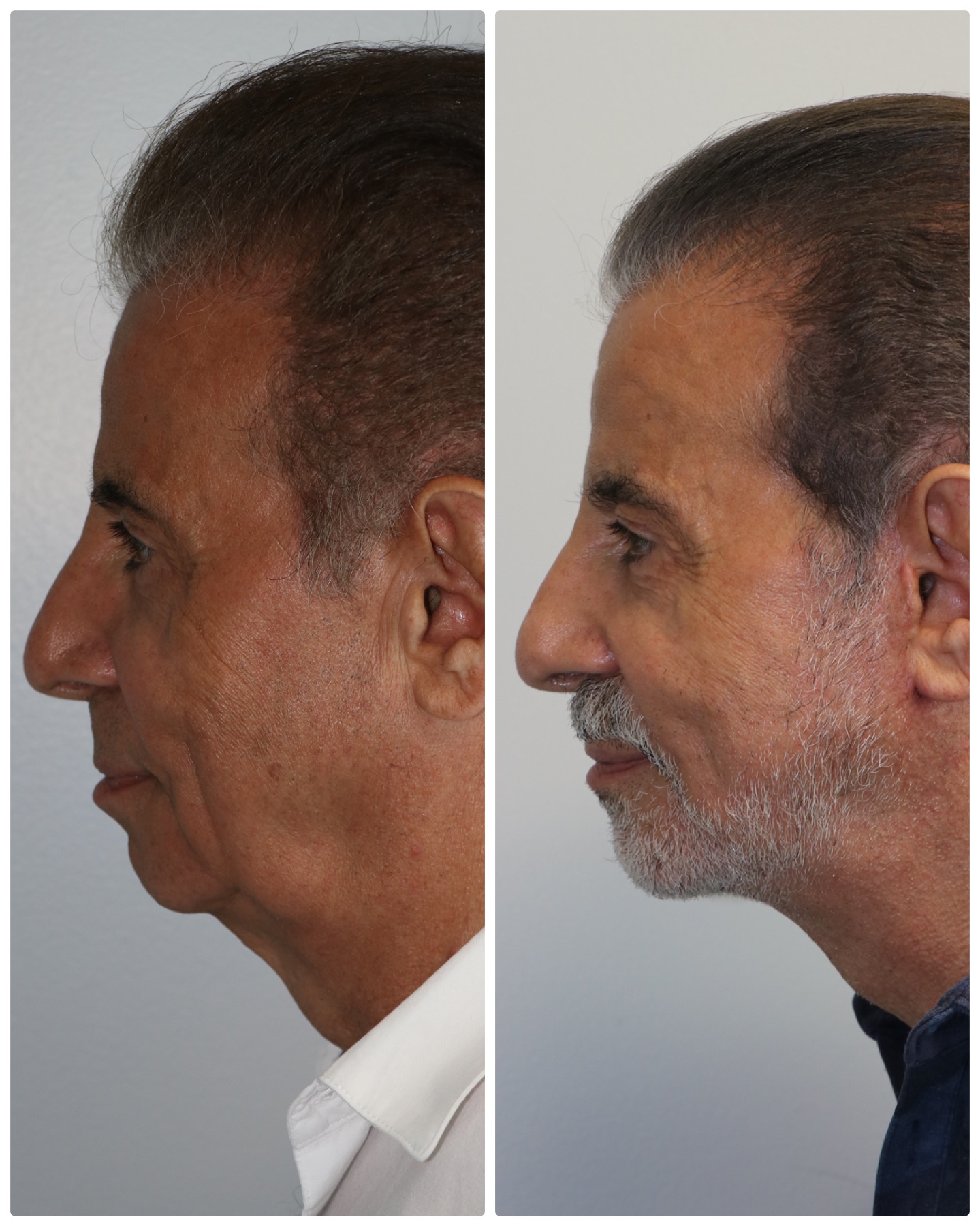 Male Neck lift
